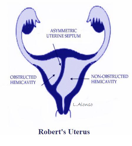 Utero de Robert – Cirugía Reproductiva Gutenberg